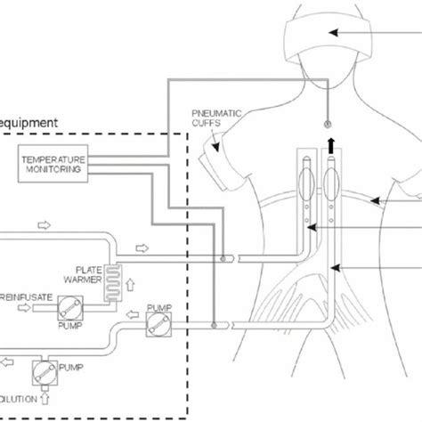 Scheme Of Isolated Thoracic Perfusion With Chemofiltration Download