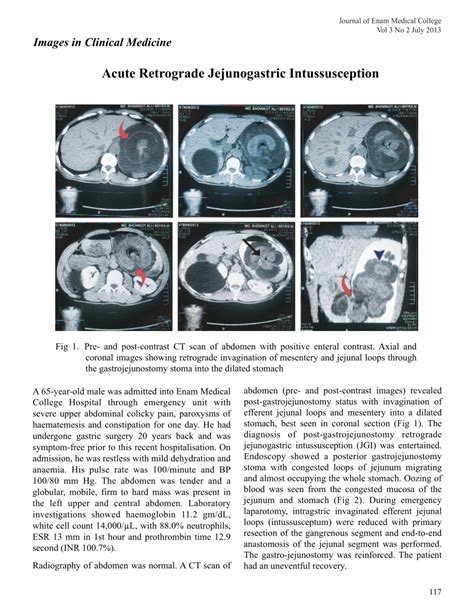 Pdf Acute Retrograde Jejunogastric Intussusception