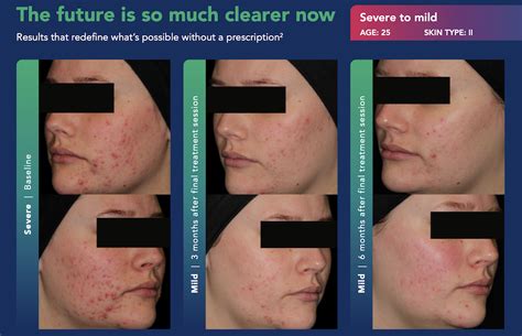 Severe Acne Minimal Dose Radiotherapy May Offer New Hope For Severe