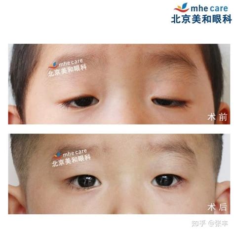 上睑下垂手术后要做的第二件大事是弱视治疗 知乎