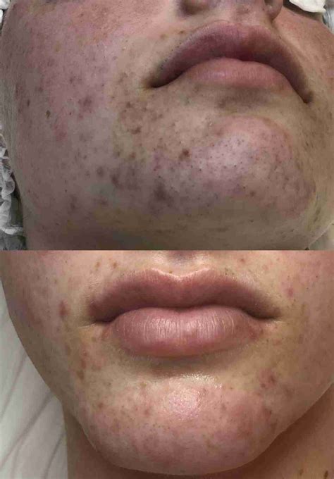 Blackhead Removal Before And After Site Loop Persons Face Before