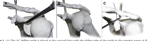 Figure 1 From Anatomic Reconstruction Of Chronic Coracoclavicular Ligament Tears Arthroscopic