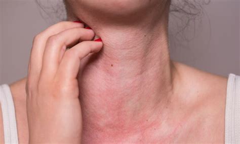 Allergiya Niyə Yaranır Maraq Dünyası