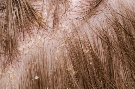 Mild Scalp Psoriasis
