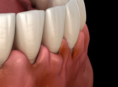 Gingivitis Inflammation Of The Gums Medically Accurate 3d Illustration