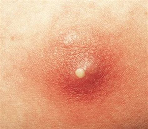 White Pimples On Vag Lips