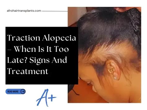 Traction Alopecia When Is It Too Late Signs And Treatment