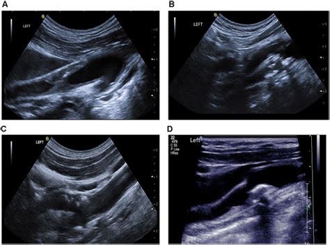 Correlation Between Calcification Characteristics Of Carotid
