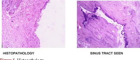 Nasal Dermoid Semantic Scholar