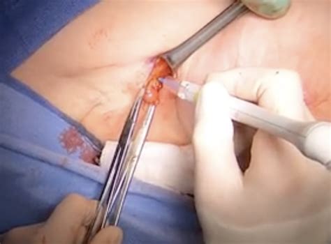 What Happens During A Lumpectomy And Sentinel Node Biopsy