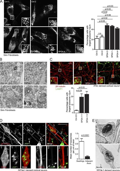 Lysosomal Abnormalities In Human Spastin Hsp Patients A Skin