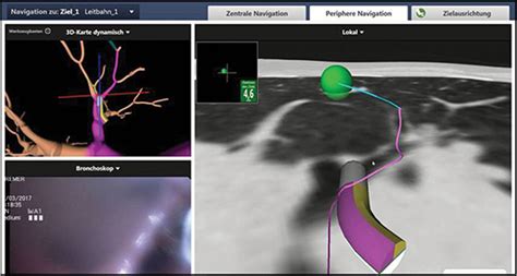 Navigational Bronchoscopy In Solitary Pulmonary Nodules Thoracic Key