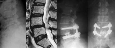 Grade 1 Anterolisthesis Of L4 On L5