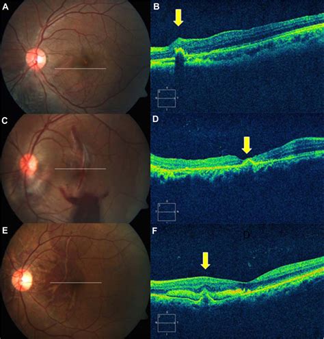 Choroidal Rupture Oct