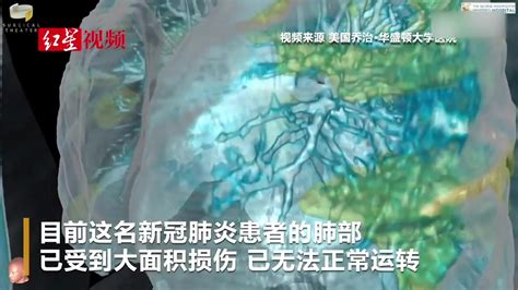 3D视频展示新冠患者肺部受损过程 哔哩哔哩 bilibili