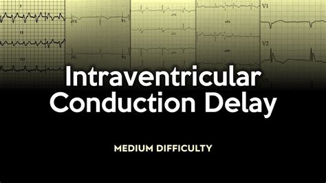 Intraventricular Conduction Delay ECG Quiz Medium Difficulty Conduction Quiz Delayed