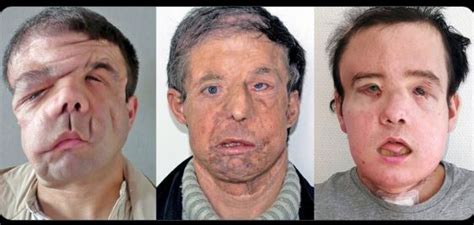 Jerome Hamon Pionier In Dubbele Gezichtstransplantatie Overleden Dagblad Suriname