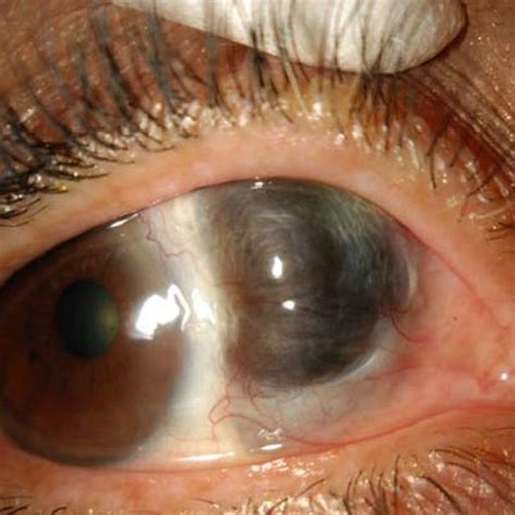 Severe Thinning Of The Sclera Following Debridement Of Infectious