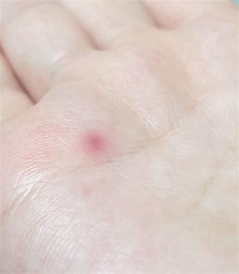 손바닥 붉은반점 지식in