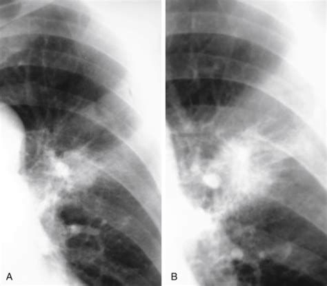 Solitary Pulmonary Nodule Radiology Key