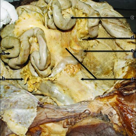 Photograph Showing The Vascular Supply Of The Right­sided Sigmoid Loop