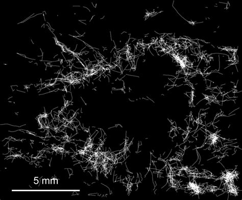 Super Resolution Ultrasound To Prevent Breast Cancer Patients From Undergoing Ineffective Therapy