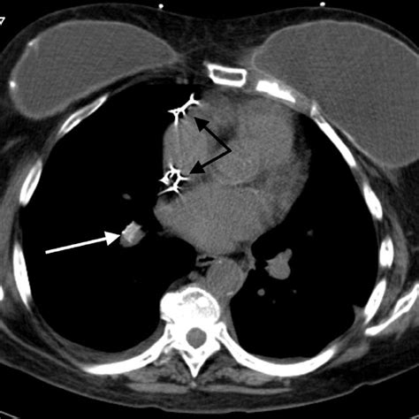 Sagittal View Ct Demonstrating A Migrated Stent In The Right Download Scientific Diagram