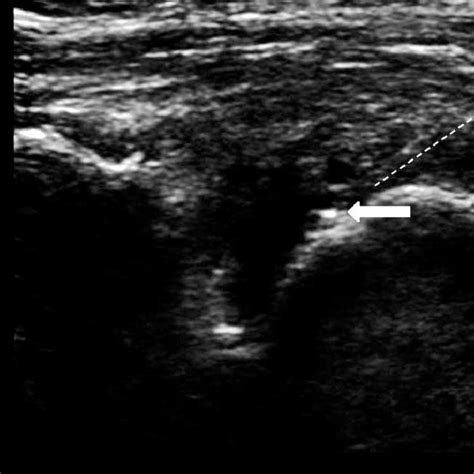 Postoperative Herniogram Of 41 Year Old Man With Left Sided Inguinal Download Scientific Postoperative Herniogram Of 41 Year Old Man With Left Sided Inguinal Download Scientific