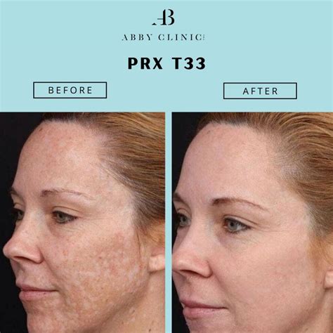 Prx T33 Treatment Dr Abby Clinic
