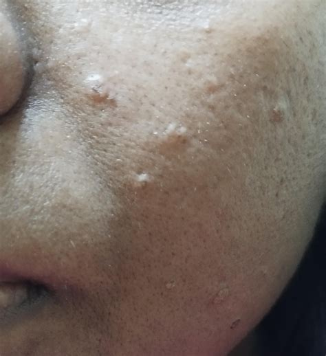 List 92 Pictures Sebaceous Cyst Pictures On Face Sharp