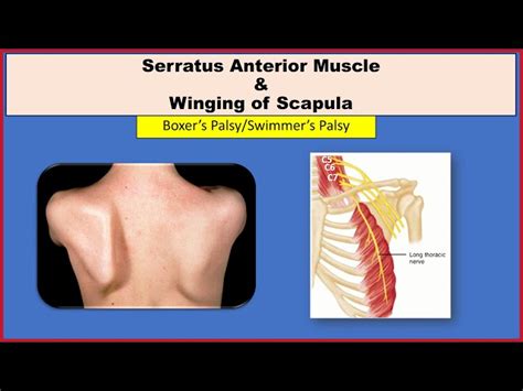 Long Thoracic Nerve Compression