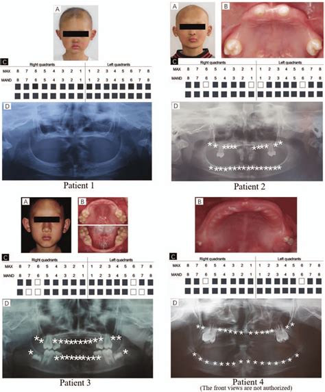 Characteristics Of Individuals With Hypohidrotic Ectodermal Dysplasia Download Scientific