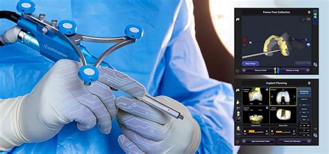 Smith And Nephew Cori Surgical System For Knee Replacements Creates