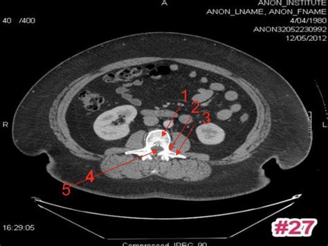 CS Unit 2 Pelvis Male Pelvic Cavity CT Flashcards Quizlet