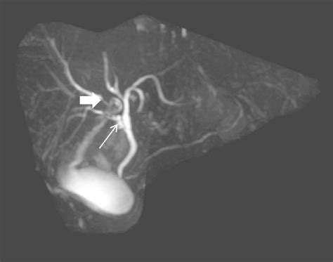 Right Posterior Duct Joining The Common Hepatic Duct Type Iiib