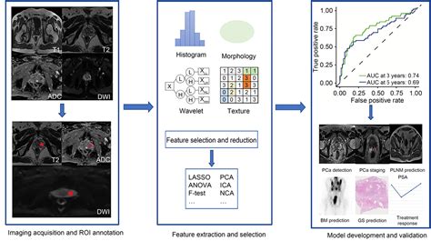 Figure 1 From Mri Derived Radiomics Models For Diagnosis Aggressiveness And Prognosis