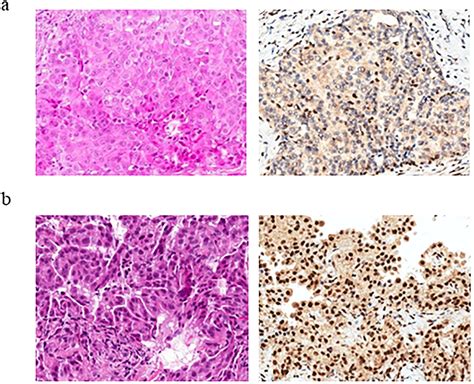Benign Mesothelial Cyst Pathology Outlines