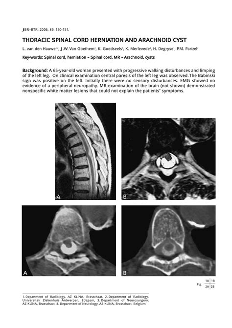 Pdf Thoracic Spinal Cord Herniation And Arachnoid Cyst