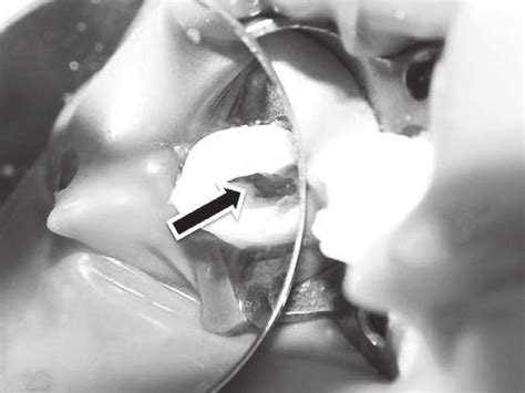 Inappropriate Access Cavity Preparation In Mandibular First Molar