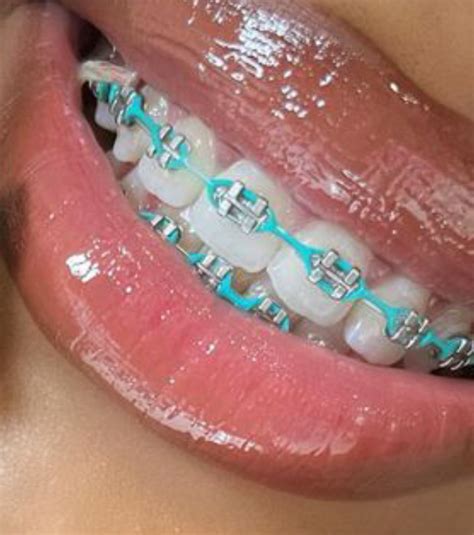 Pin By Rita On Collage Item Pins Braces Colors Cute Braces Cute