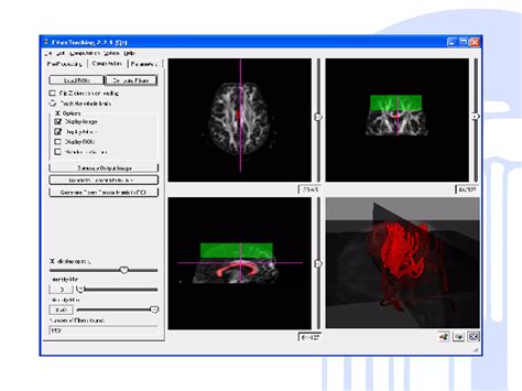 A Quantitative Dti Fiber Tract Analysis Suite 898 Ppt