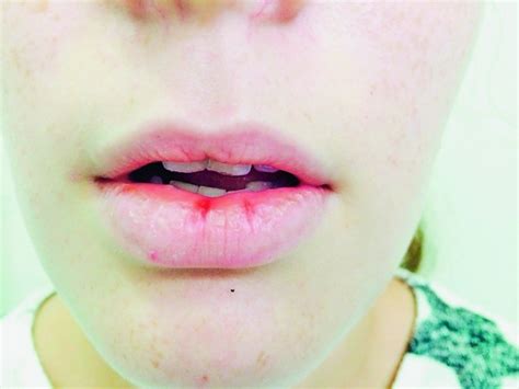 Differential Diagnosis Of Cheilitis How To Classify Cheilitis Life