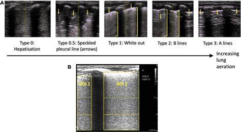Lung Ultrasound During Newborn Resuscitation Predicts The 45 Off