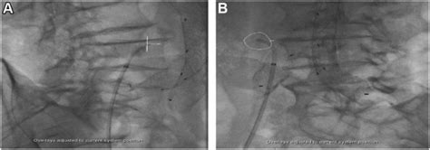 A Novel Technique And Outcomes For Transcaval Endoleak Embolization