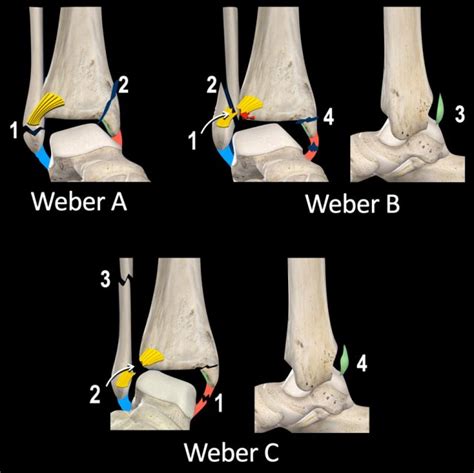Types Of Fibular Fractures