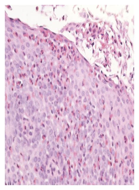 A Eosinophilic Esophagitis With Eosinophilic Microabscess Showing