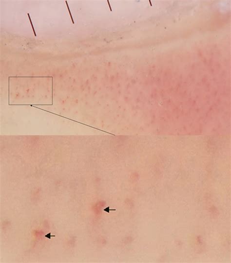 Racgp Nailfold Dermatoscopy In General Practice