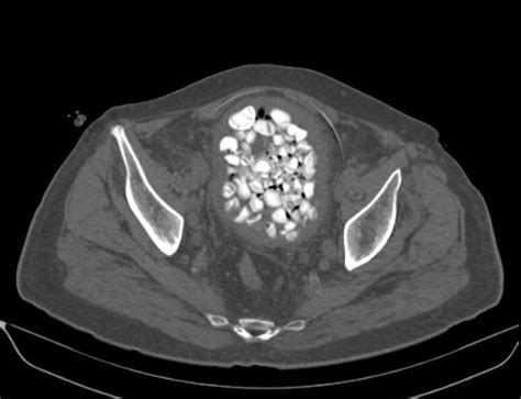 Bladder Calculus Pacs