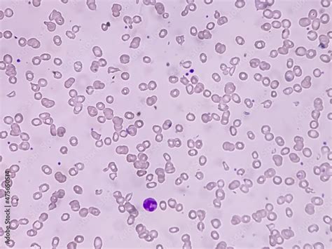 Macrocytic Anemia With Features Of Hemolysis And Nucleated Rbc Analyzed