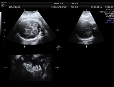 Choroid Plexus Cyst Looking Through A Transducer